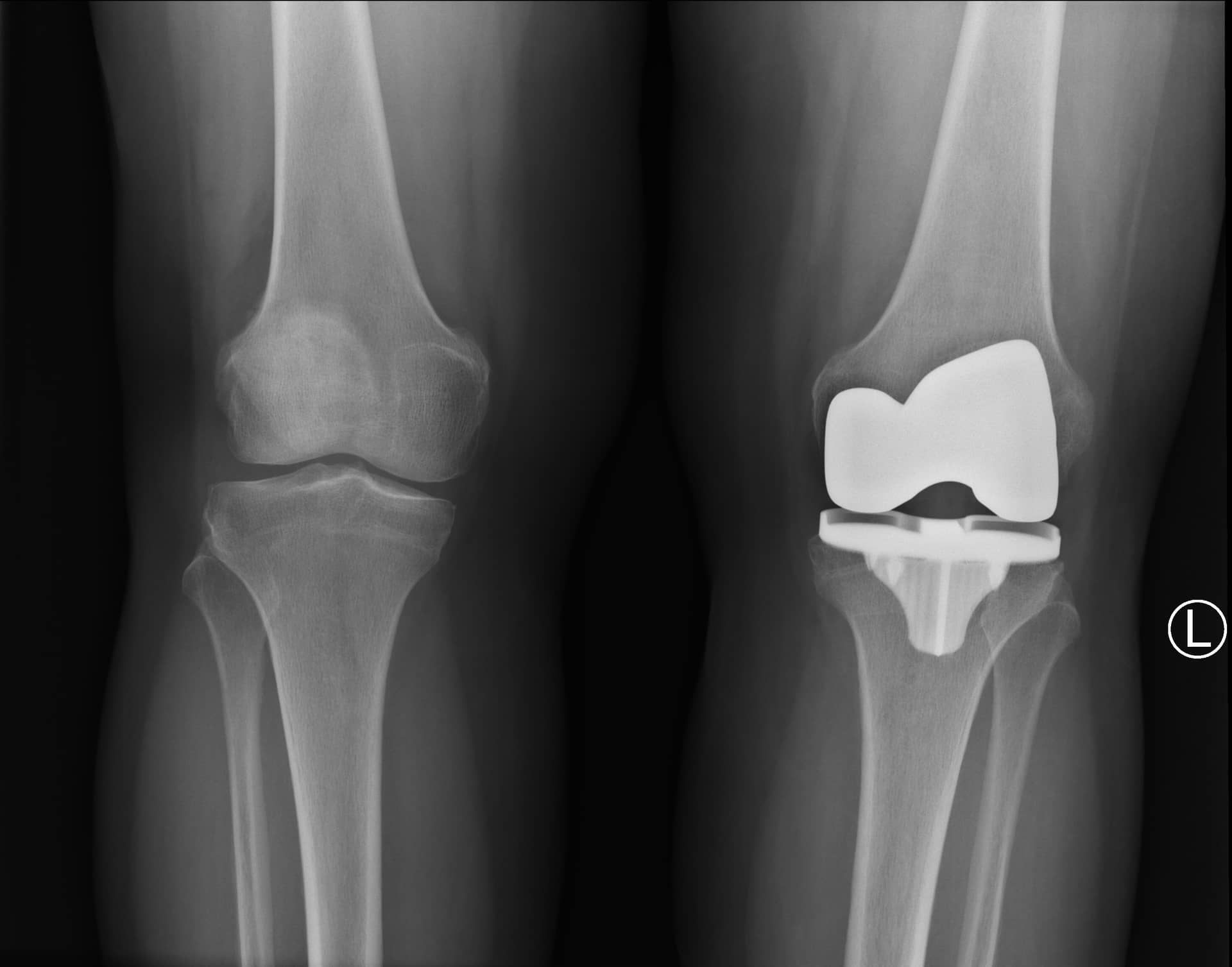 Mako Robotic-Arm Assisted Total Knee Arthroplasty | Journal of Medical ...