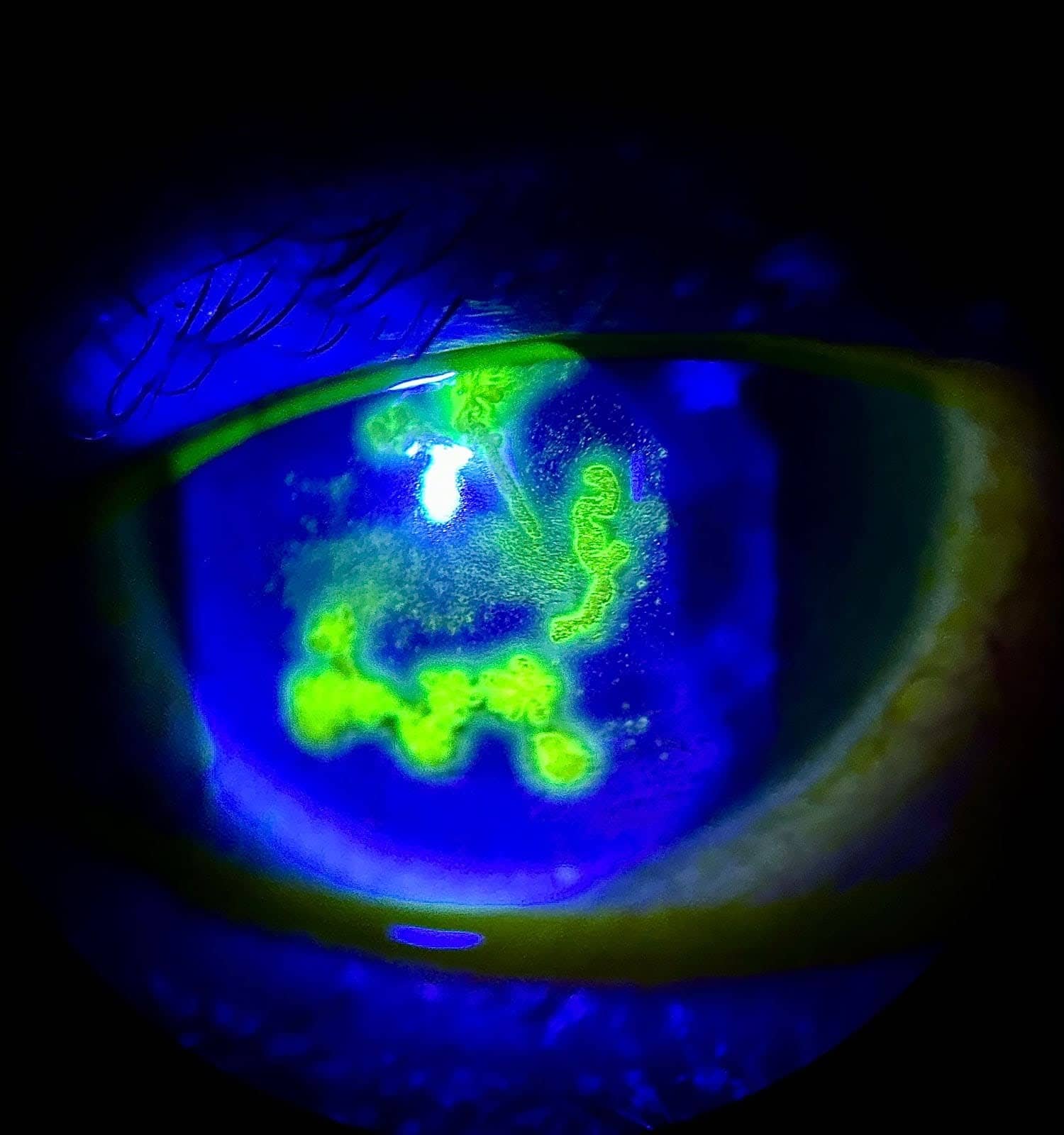 Corneal Staining with Fluorescein | Journal of Medical Insight