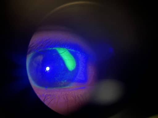 Corneal Staining with Fluorescein | Journal of Medical Insight