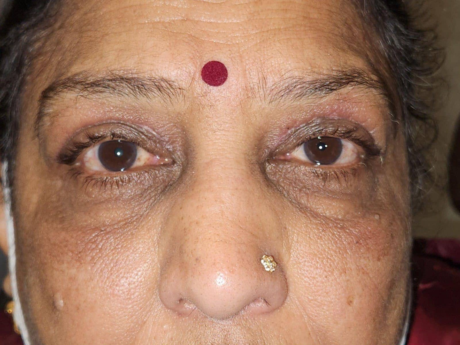 Blepharoplasty for Bilateral Upper Eyelids | Journal of Medical Insight
