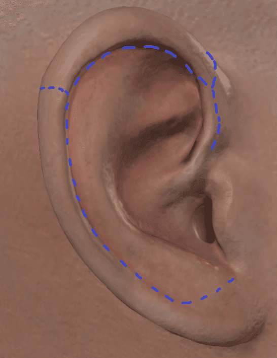 Local Tissue Advancement: Reconstructing Superior Helical Rim Defect ...