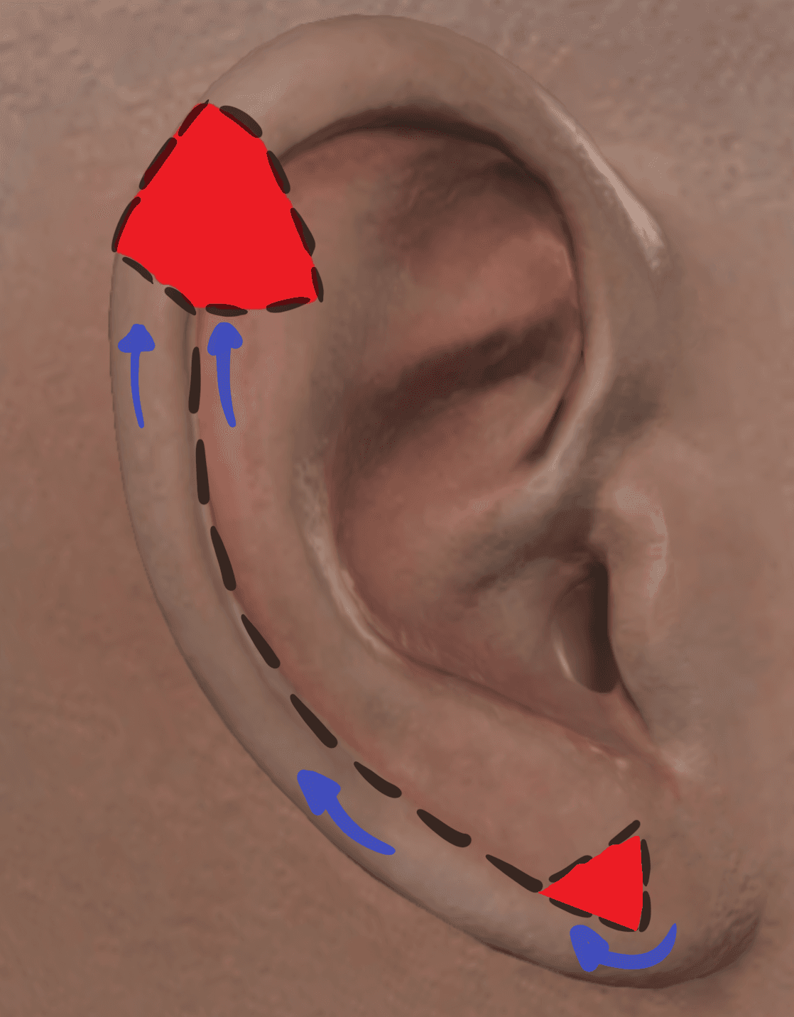 Local Tissue Advancement: Reconstructing Superior Helical Rim Defect ...