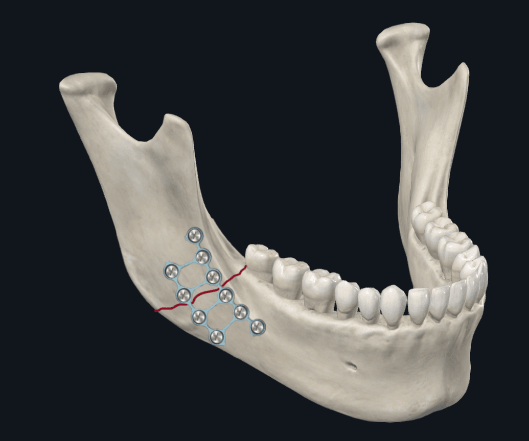 Open Reduction and Internal Fixation of Mandibular Body and ...