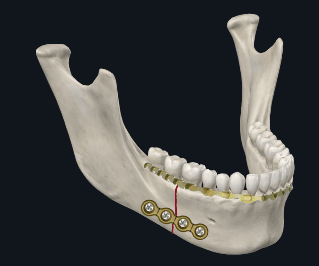 Open Reduction and Internal Fixation of Mandibular Body and ...
