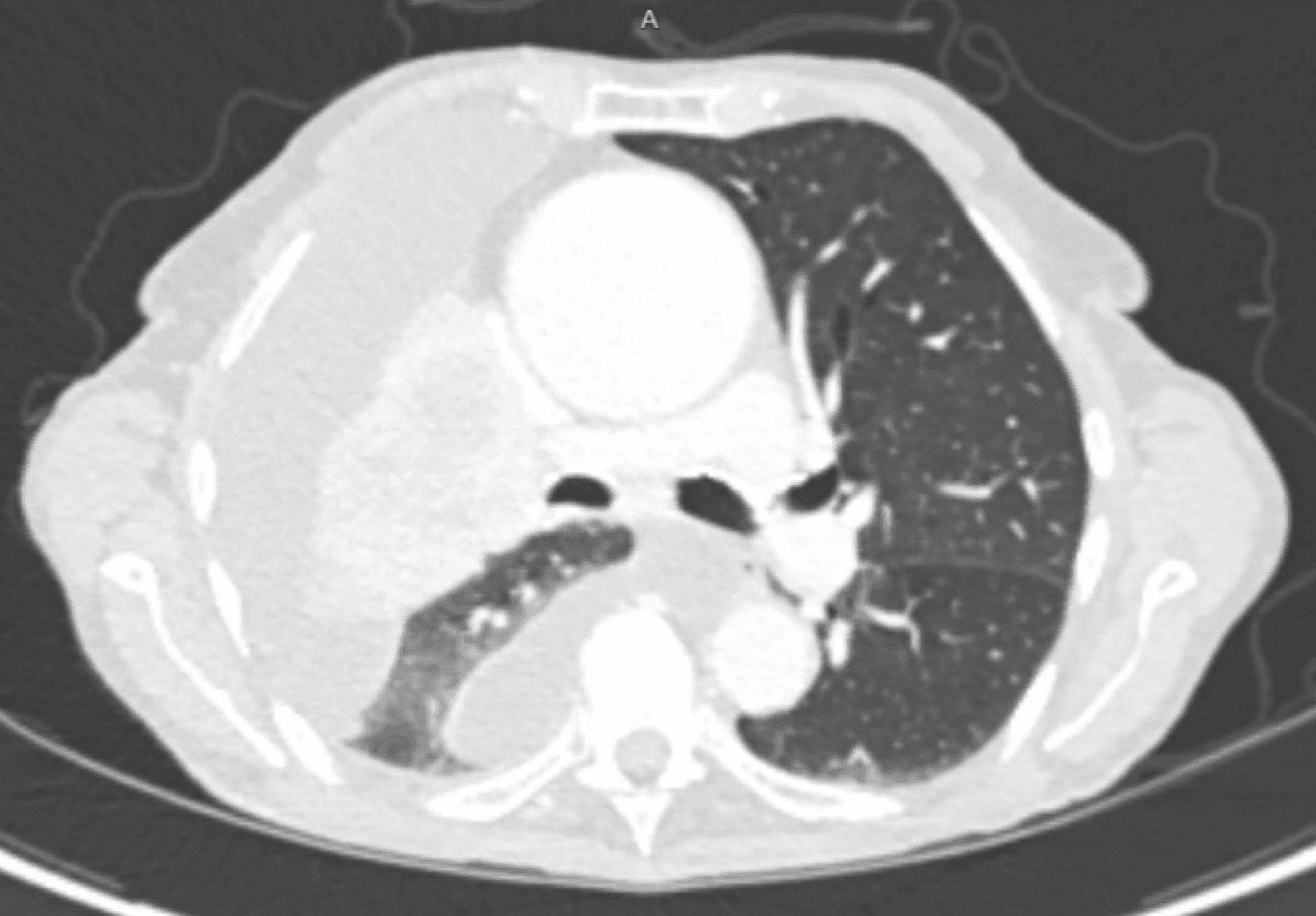 Insertion of a Right-Sided PleurX Catheter for Palliation of a ...