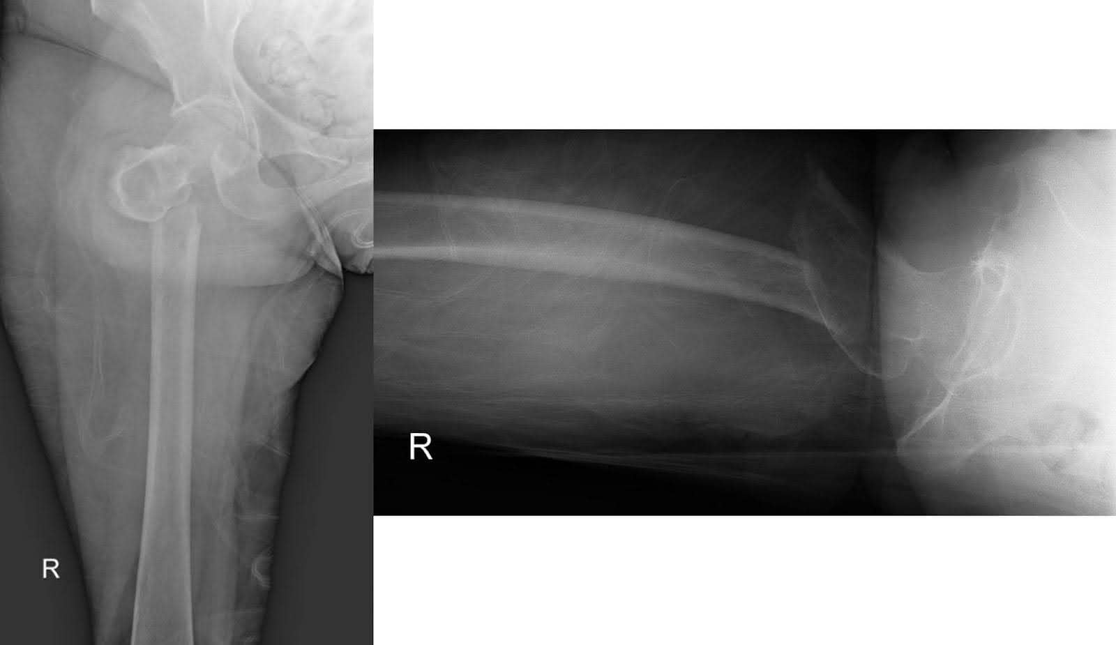 Carbon Fiber Implant for Fixation of a Pathologic Subtrochanteric ...