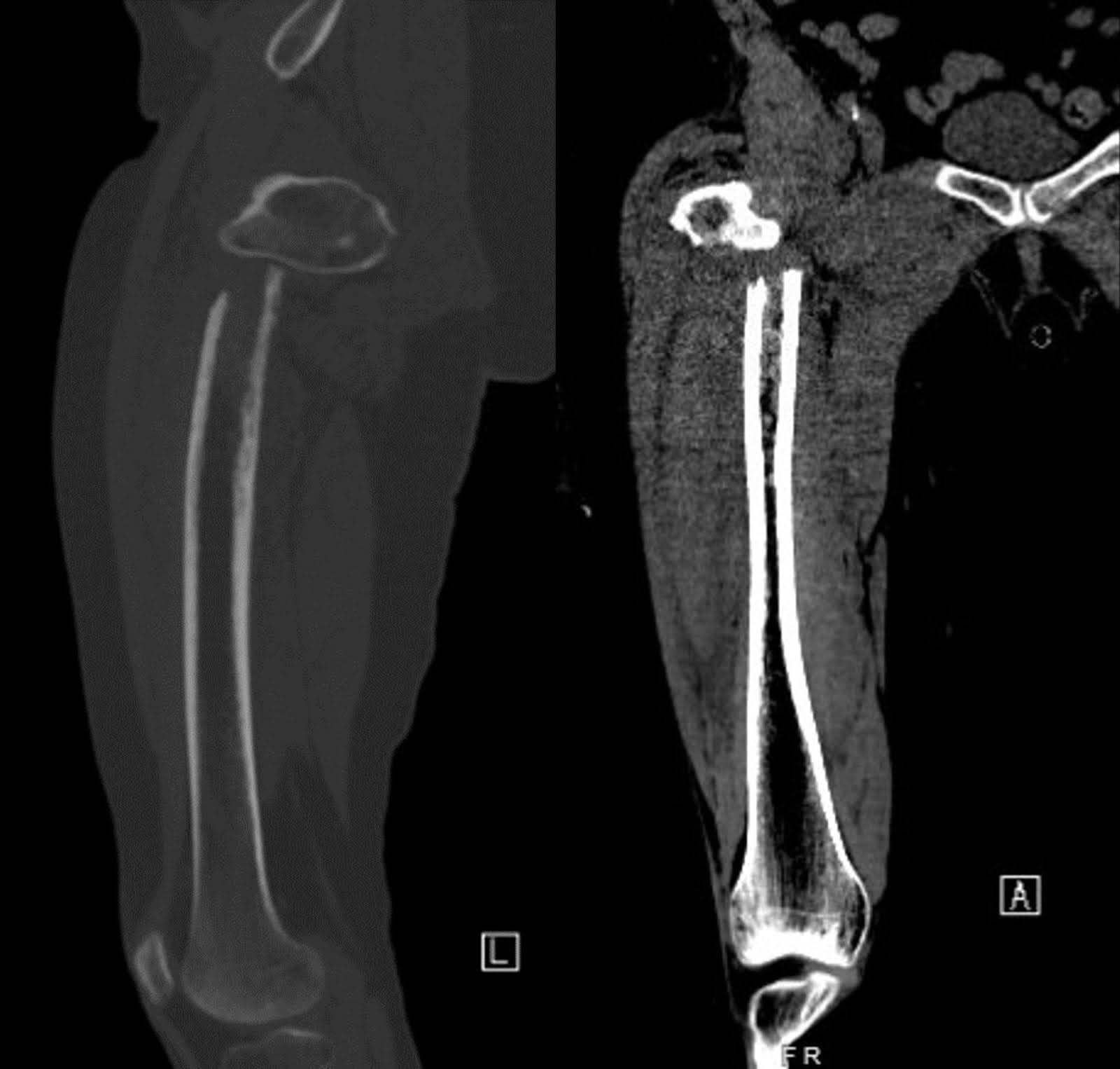 Carbon Fiber Implant for Fixation of a Pathologic Subtrochanteric ...