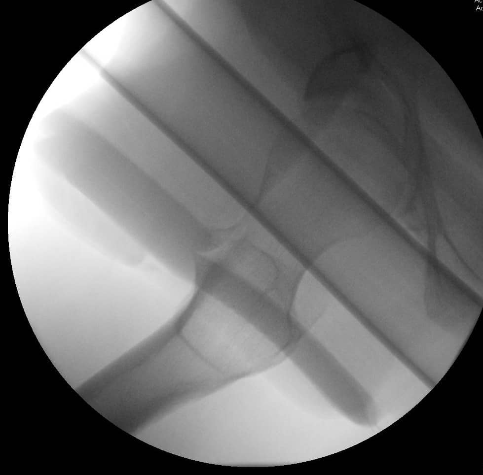 Hip Arthroscopy with Acetabular Osteoplasty and Labral Repair | Journal ...