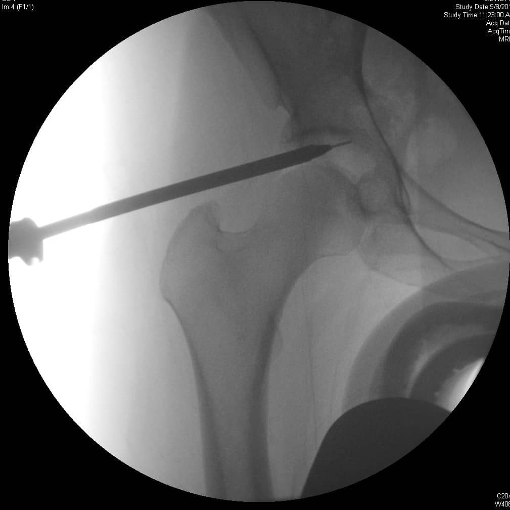 Hip Arthroscopy with Acetabular Osteoplasty and Labral Repair | Journal ...