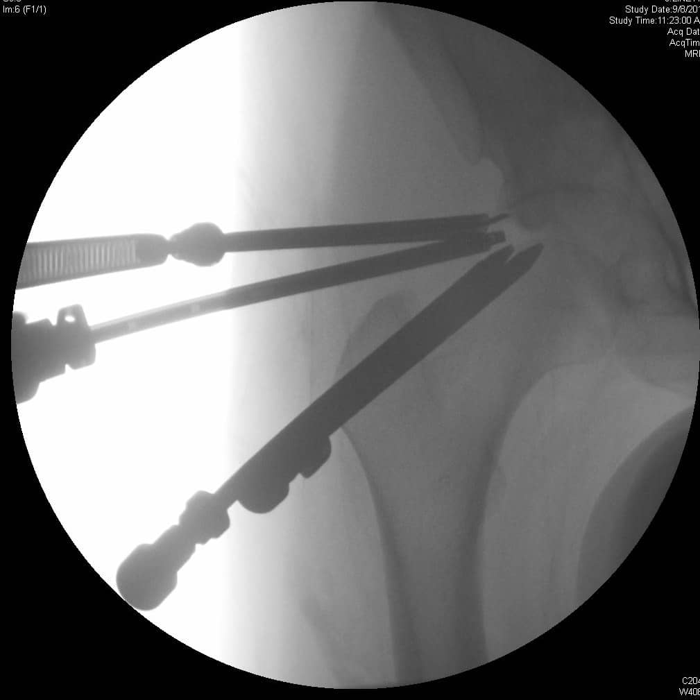 Hip Arthroscopy with Acetabular Osteoplasty and Labral Repair | Journal ...
