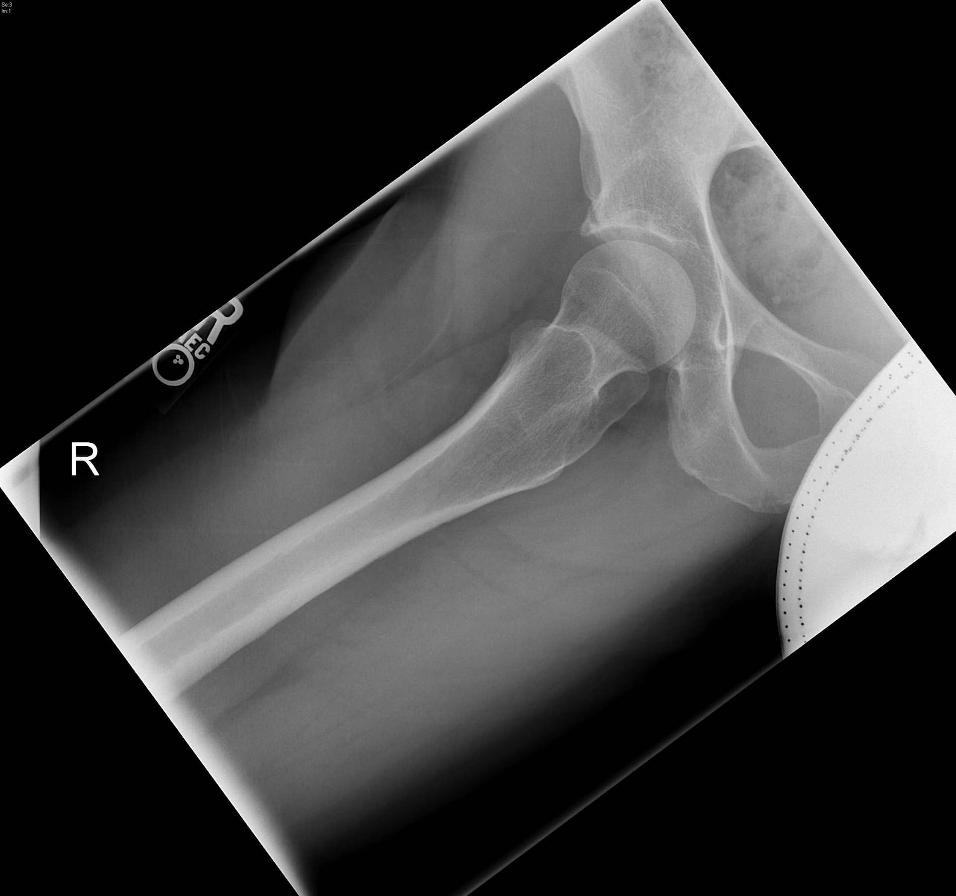 Hip Arthroscopy with Acetabular Osteoplasty and Labral Repair | Journal ...