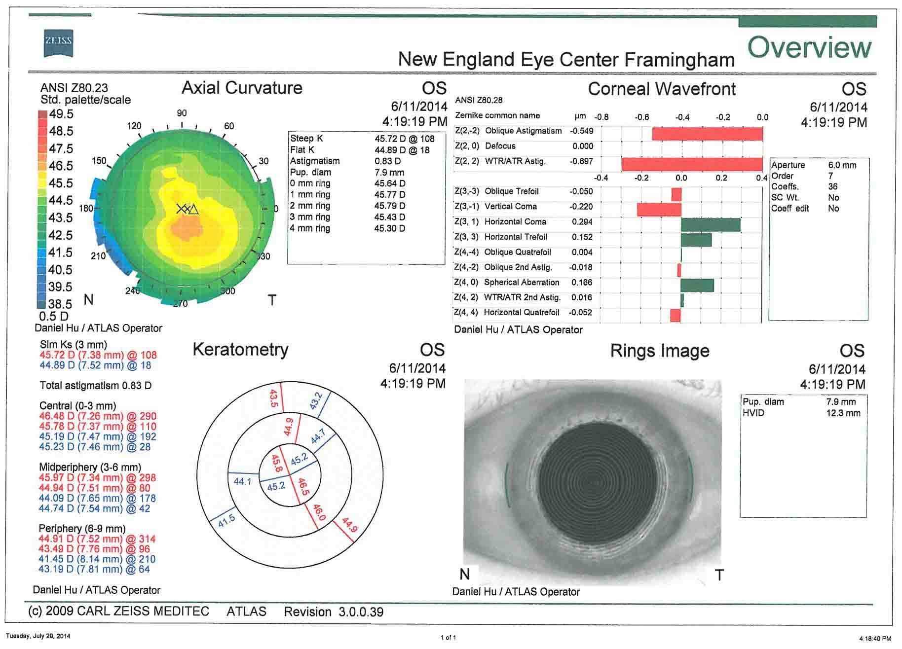 Cataract Extraction with Phacoemulsification and Posterior Chamber ...
