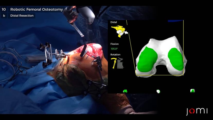 Mako Robotic Arm Assisted Total Knee Arthroplasty | JOMI