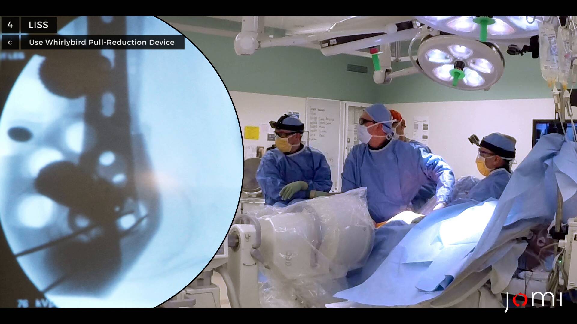 Less Invasive Stabilization System (LISS) for Distal Femur Fracture ...