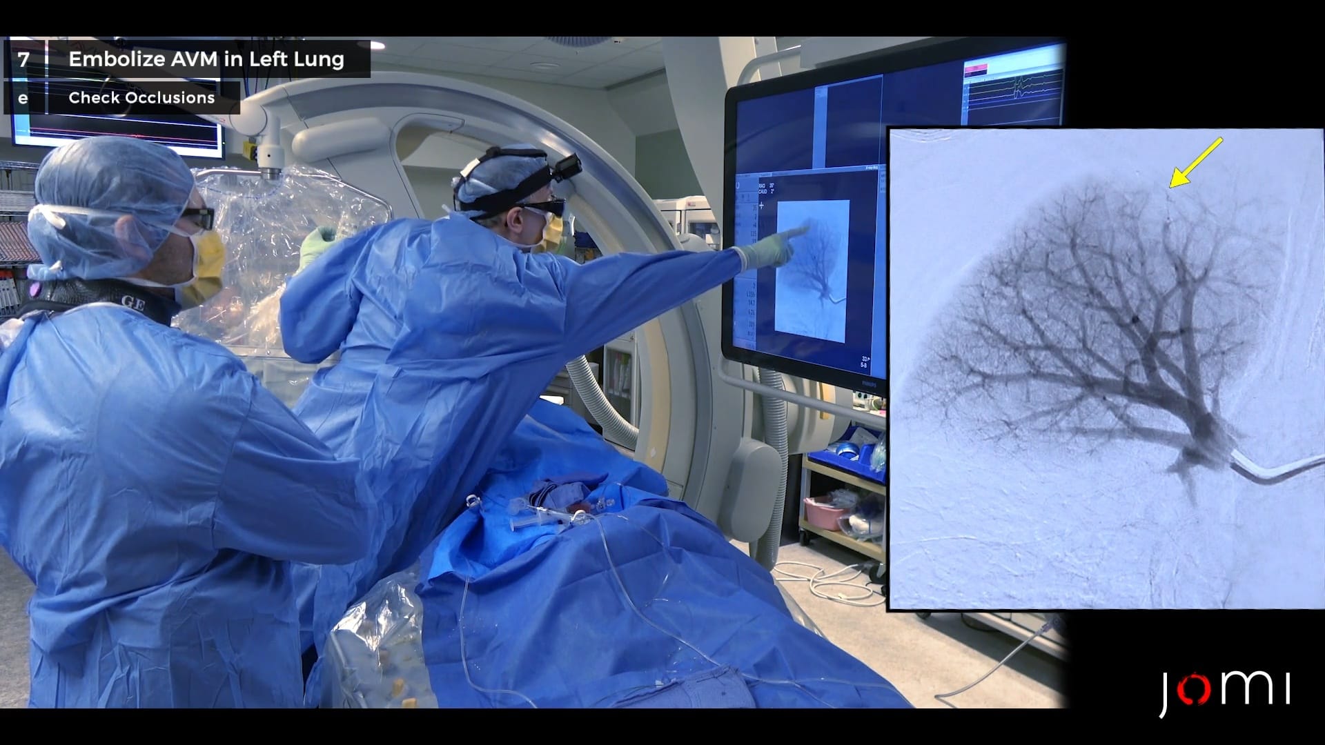 Pulmonary AVM Embolization | JOMI