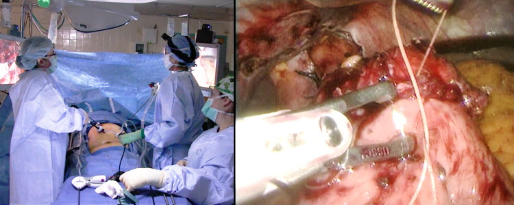 Ja RYGB手術後の辺縁潰瘍へのアプローチ:縁潰瘍の腹腔鏡切除および後腹痛によるルー四肢の後腹側迂回、トランク迷走術および食道裂孔ヘルニア ...