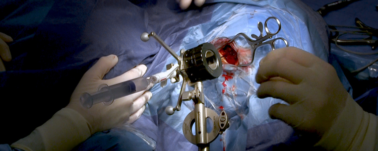 Ja 小脳リンパ腫の疑いによる脳生検 | Journal of Medical Insight