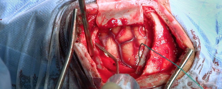 It Evacuazione acuta dell'ematoma subdurale | Journal of Medical Insight