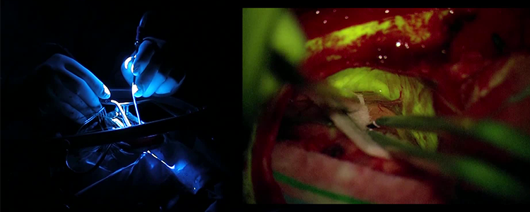 It Resezione microchirurgica di una fistola arterovenosa durale ...