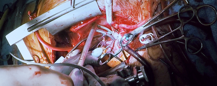 Transcript Cox-MAZE IV with Coronary Artery Bypass Graft (CABG) and ...