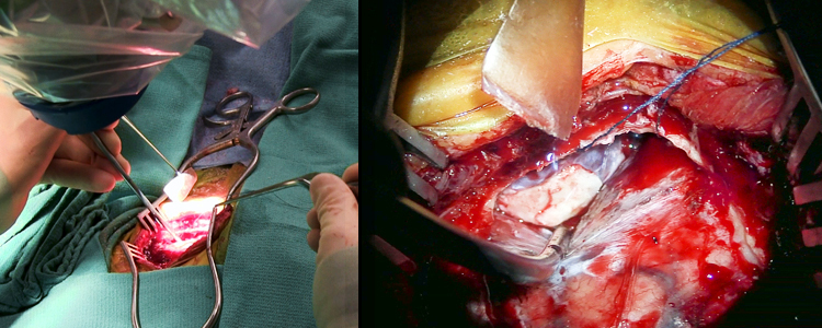 Ja 中部窩の脳脊髄液漏れ修復アプローチ | Journal of Medical Insight