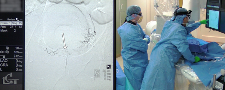 Procedure Outline Embolización de la arteria prostática (PAE) | Journal ...