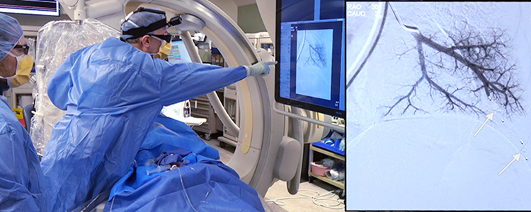 Embolización pulmonar de MAV | JOMI