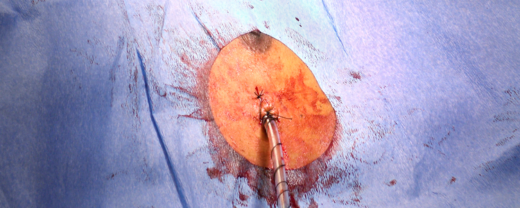 Ja 気胸のための左管胸腔造開術 | Journal of Medical Insight