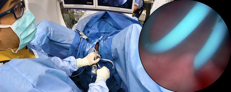 Ja 膀胱鏡検査、右尿管鏡下、尿管ステント挿入(生検中止および右腎腫瘤のレーザーアブレーションの可能性)を行います | Journal of ...