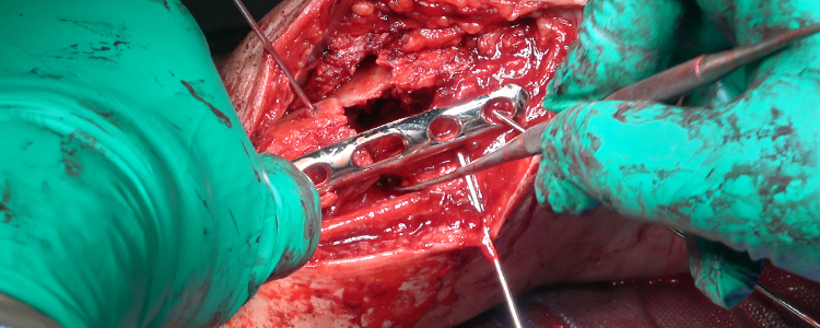 Ja 左脛骨ピロン開閉骨折、開放復位および外固定器を用いた内固定 | Journal of Medical Insight