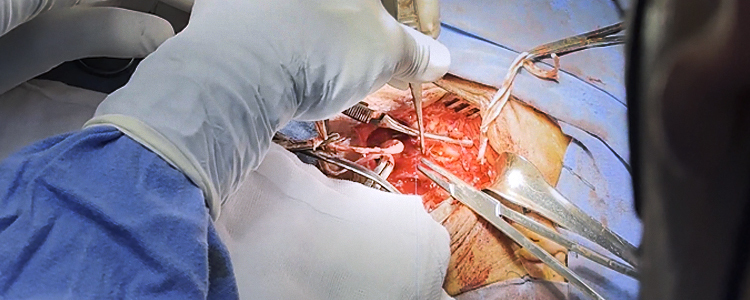 Ja 経頸椎内頸動脈瘤の経頸部開閉修復術 | Journal of Medical Insight