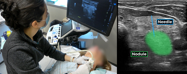 Thyroid Biopsy: Fine-Needle Aspiration for Multinodular Goiter ...