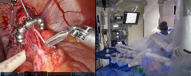 Robotic Paraesophageal Hernia Repair with Magnetic Sphincter ...