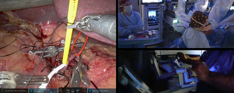 Ja 血管支持および肝内転移を伴う切除不能な肝内胆管癌に対する肝動脈輸液(HAI)ポンプ設置 | Journal of Medical Insight