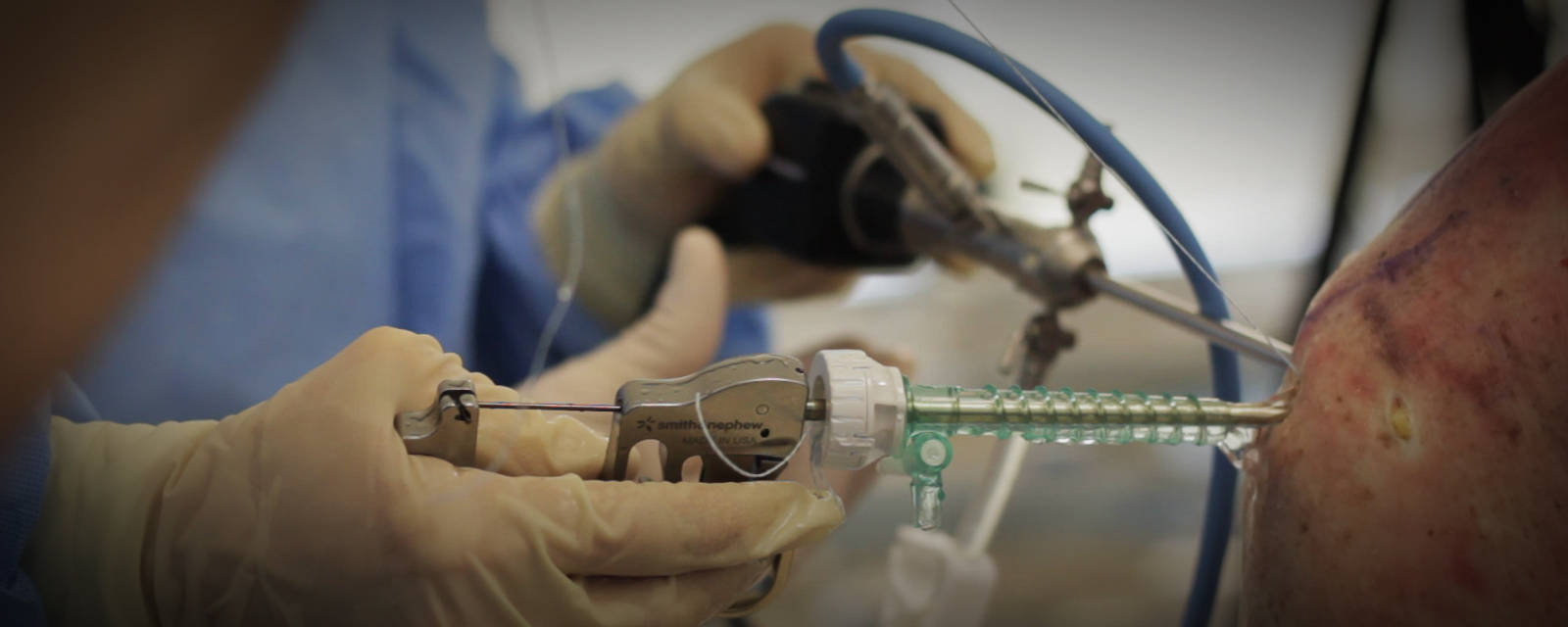 Hagl Lesion Is Only A Fixed By Surgery