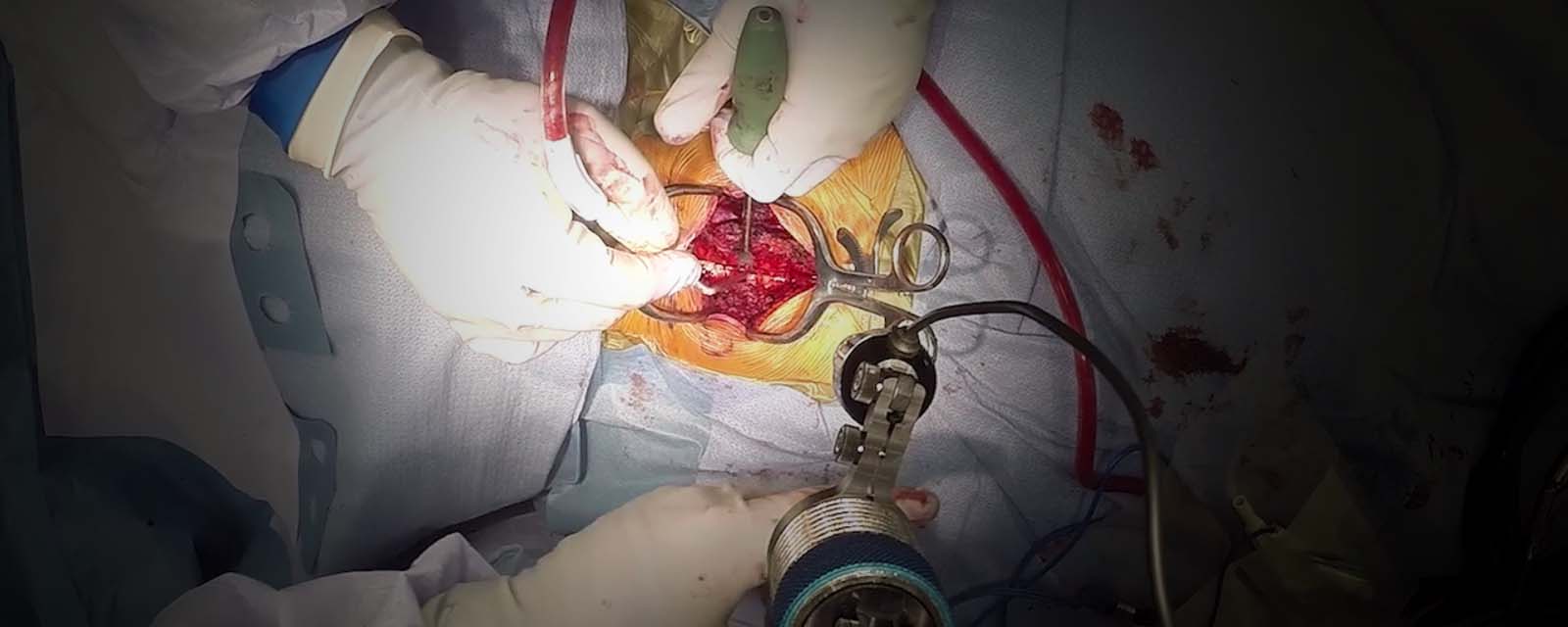 Video 頸椎椎間成形術 | Journal of Medical Insight